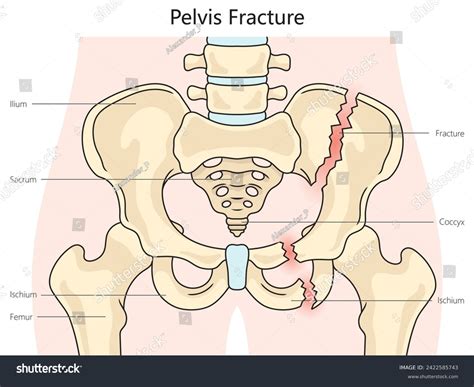 Pelvic Pelvis Fracture Structure Diagram Hand Stock Vector Royalty