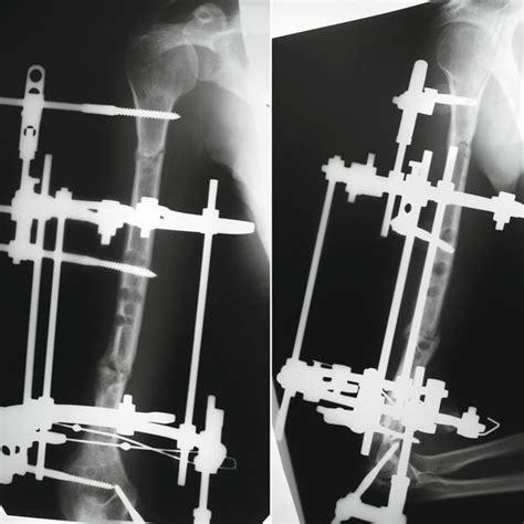 Pdf The Basic Principles Of External Skeletal Fixation Using The