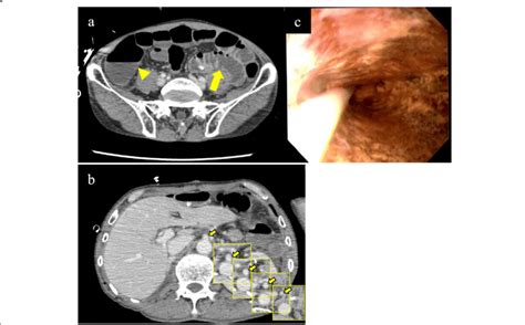 Computed Tomography Ct And Endoscopy At Postoperative Day 2 Following