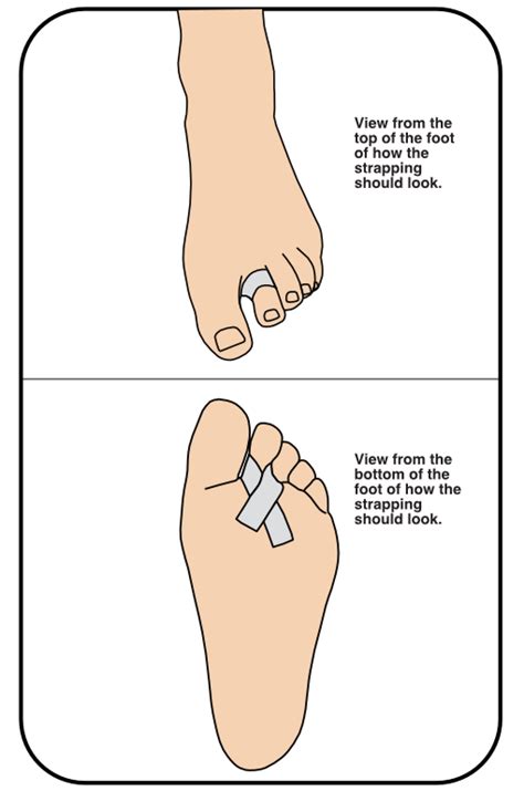 Lesser Toe Deformities Nhs Lanarkshire