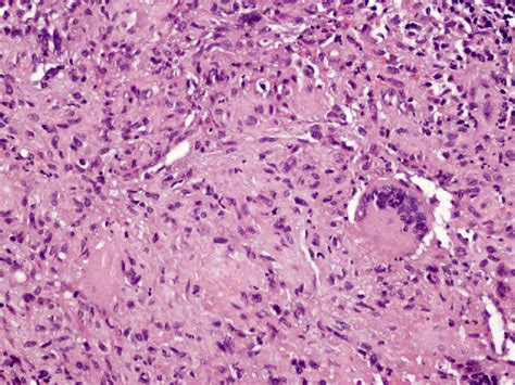 Periorificial Cutaneous Tuberculosis Of The Vulva Actas Dermo Sifiliográficas
