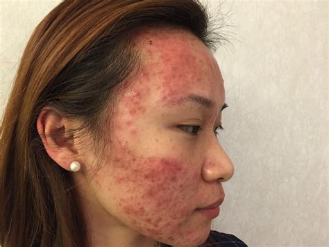 Dr Gerard Ee Clifford AGNES The PERMANENT Cure For Adult Acne Pimples
