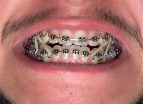 Amazing Non Surgical Underbite Correction Braces 1 Year Rbraces
