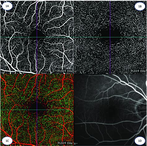 A 3 Mm 3 Mm OCTA Image Of The Superficial Capillary Plexus In The Download Scientific