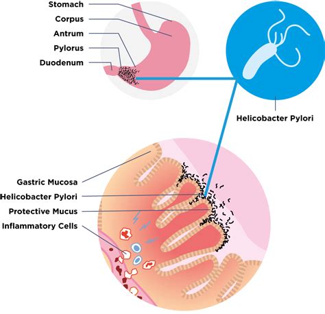 Helicobacter Pylori