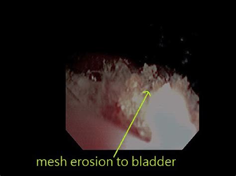 Bladder Sling Surgery Problems At Roy Bush Blog