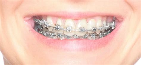 ¿los Brackets Causan Caries 5 Posibles Síntomas