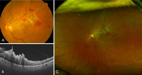 Photographs Of The Left Eye 14 Days After Intravitreal Injection Of