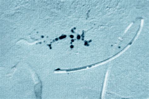 Chemoembolization Stock Image C0244410 Science Photo Library