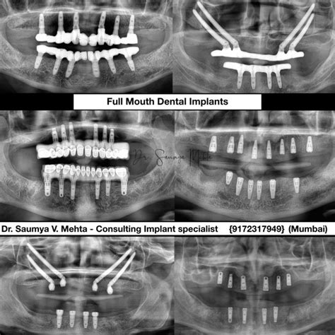 dr saumya mehta on linkedin full mouth implant specialist
