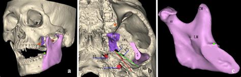 Infratemporal Space A Exposure Of The Infratemporal Fossa Is Achieved