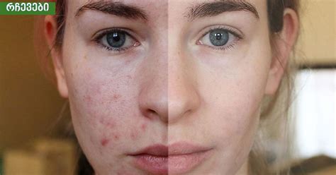 თუ აკნე ცხიმიანობა და ფერიმჭამელები გაწუხებთ ეს ნიღაბი ყველაზე დიდ შედეგს მოგცემთ