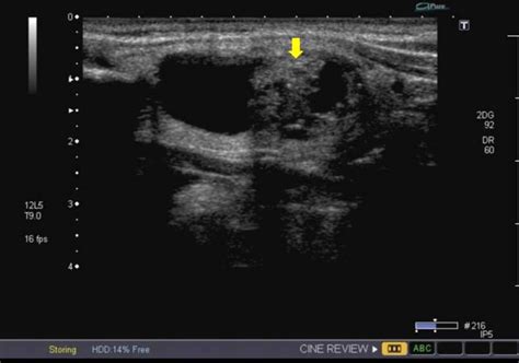 Female 33 Yo In A A Predominantly Solid And Hypoechoic Nodule With Download Scientific