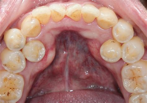 Supernumerary Teeth Extraction