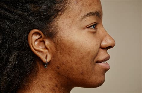 Addressing Hyperpigmentation Products And Tips Mucin Beauty