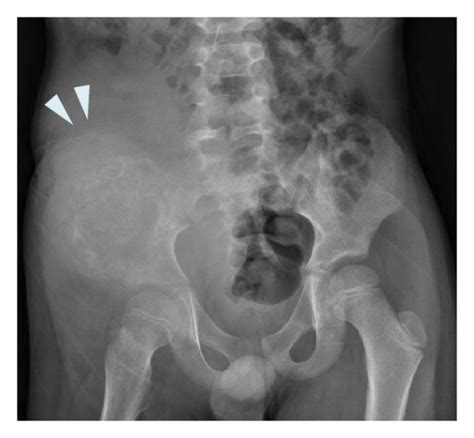 A Preoperative Anteroposterior Radiograph Of The Pelvis Of A