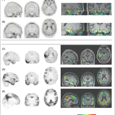 A B “mtl Only” With A Emerging Perirhinal Entorhinal Signal And B Download Scientific