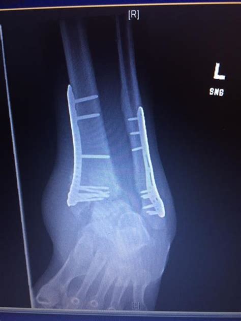 The Failed Diabetic Ankle Fracture Is A Limb Threatening Situation Surgical Options Include
