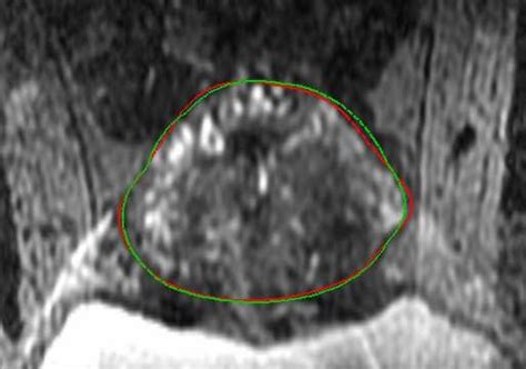 3d Prostate Segmentation Result Green Contour By The Proposed Method