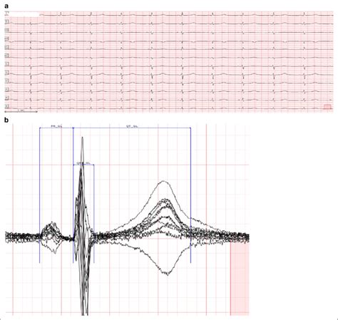 ECG With QT And QTc Undermeasured By ECG Device Centralized Download Scientific Diagram