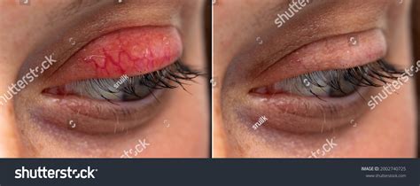 Eye Makeup For Blepharitis Sufferers