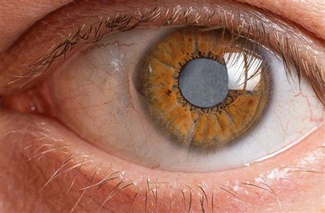 Brown Cataracts Meaning Causes Diagnosis And Treatment