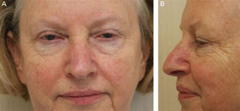 Scalp Flap Surgery Before After Mapasgmaes