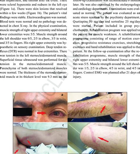 A Scleral Hyperemia And Redness In The Left Eye Of Case 1 B Linear