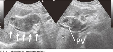 Figure 1 From A Case Of Schwannoma Arising From The Nerve Plexus Around The Common Hepatic