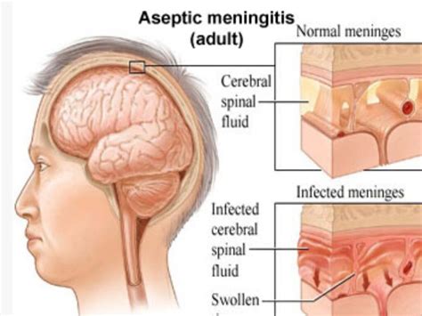 The Basics Of Aseptic Meningitis Independent Newspaper Nigeria