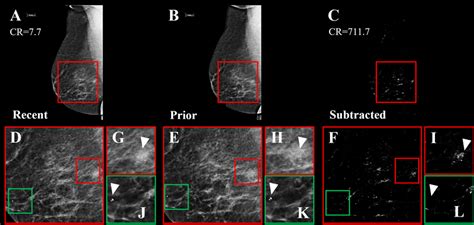 Improvement Of The Cr And Subtraction Of Pre Existing Mcs A Most Download Scientific Diagram