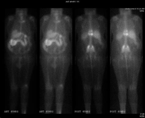 Whole Body Gallium Scan Notes The First 2 Images From The Left Show Download Scientific