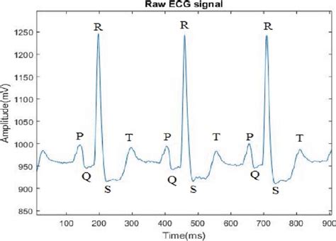 peaks in a normal ecg signal download scientific diagram