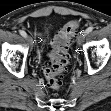 Diverticulitis Radiology Key