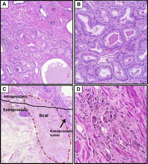Iatrogenic Extraprostatic Extension Of Prostate Cancer From A Needle