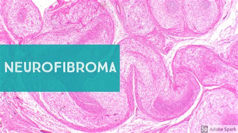Plexiform Neurofibroma Histopathology