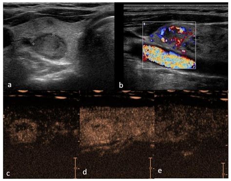 Ultrasound Thyroiditis