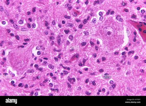 Photomicrograph Of Hematoxylin Eosin Hande Stained Brain Tissue From A Rabies Encephalitis