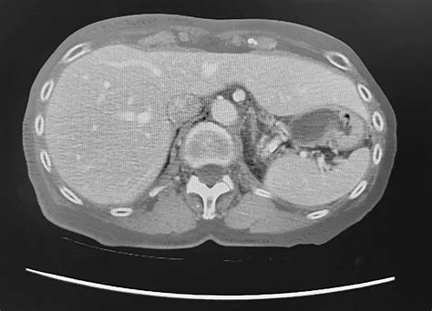 Decoding The Deception A Case Report Of Gallbladder Volvulus Mimicking Acute Cholecystitis