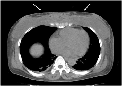 Imaging Of Ct Showed An Abscess On The Chest Wall Download