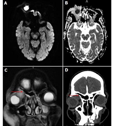 A Axial Diffusion Weighted Imaging Mri Of The Orbits Without Contrast