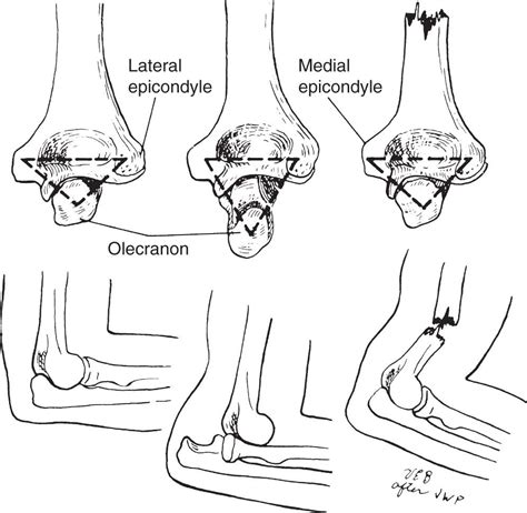 Elbow And Forearm Injuries Musculoskeletal Key