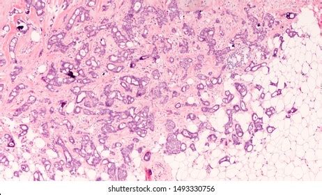 317 Lumpectomy Images Stock Photos Vectors Shutterstock