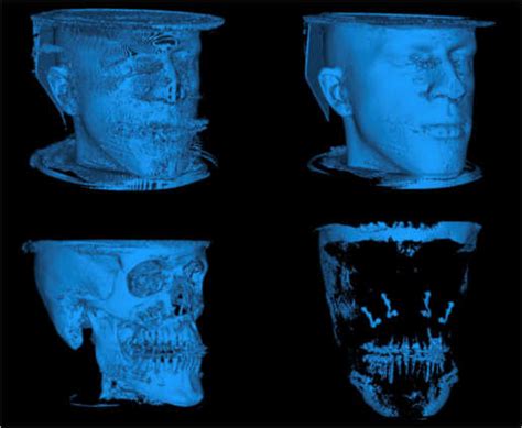 Cbct Volume After Binarization For Different Threshold Values