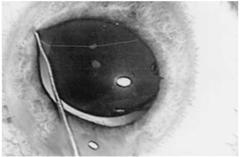 Posterior Capsule Tear Resulting From Faulty Instrumentation