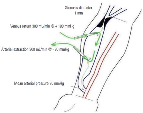 The Hemodynamic Effect Of A Severe Outflow Stenosis On Dialysis Rc Avf