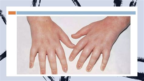 Overlap Syndrome 1 Pptx