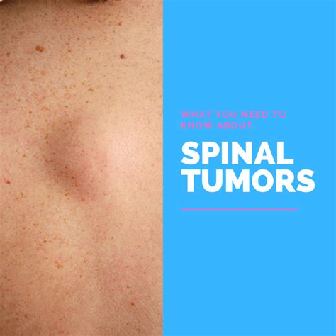 Spinal Cord Tumor Symptoms Spinal Cord Tumors Examples Ogew