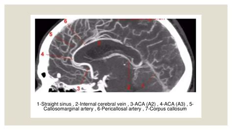 Anterior Cerebral Artery Anatomy Segments Pathologies Radiology Pptx