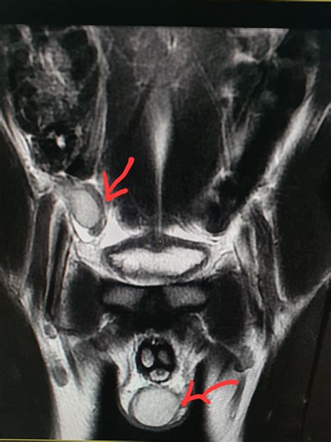 Imen Ganzoui Op Linkedin Ectopic Right Testicle In An Adult Mri T2 Wi